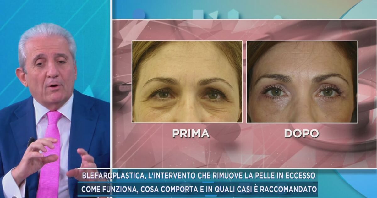 Mattino Cinque: Blefaroplastica, l'intervento che rimuove la pelle in ...